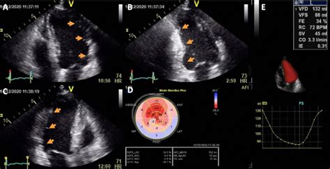 Cardiac Multimodality Imaging Assessment Of Dystrophic Myocardial Calcification In A Human