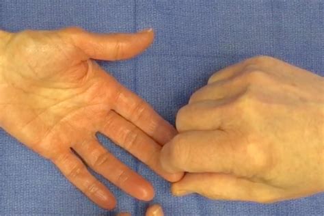 Median Nerve In Carpal Tunnel Anatomic Structures At Risk