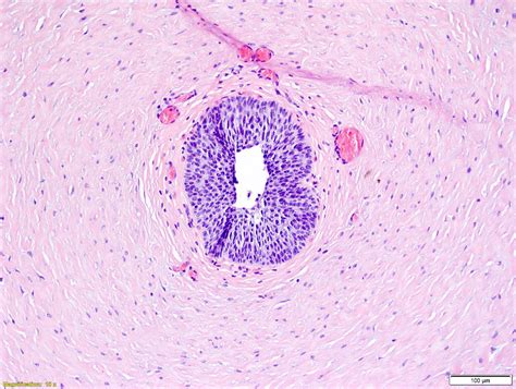 Urachal Cyst Histology