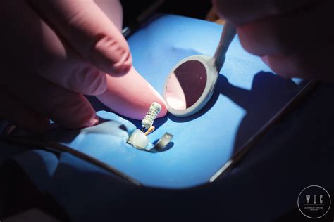 Apicoectomy Explained When Root Tip Surgery Is Needed