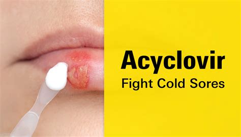 Acyclovir For Cold Sore Treatment