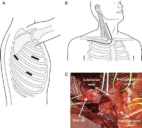 Schema Of The Surgical Approach And Intraoperative View Firstly The Patient Was Positioned In