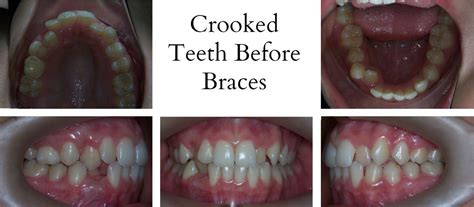 Braces On Ugly Teeth At Beth Anker Blog Braces On Ugly Teeth At Beth Anker Blog
