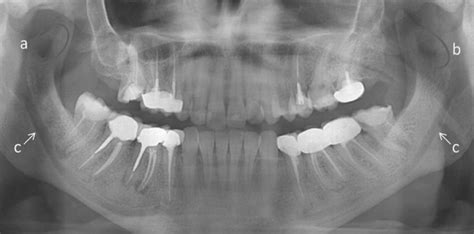 Panoramic Radiograph Revealed An Unusual Radiolucency On The Coronoid