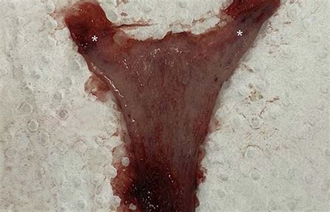 A Rare Case Of En Bloc Endometrium Shedding The Trocar