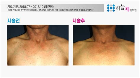 진균성 모낭염 치료 전후 사진 Youtube