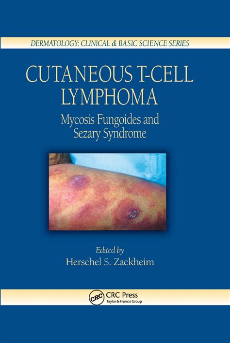 Cutaneous T Cell Lymphoma Mycosis Fungoides And Sezary