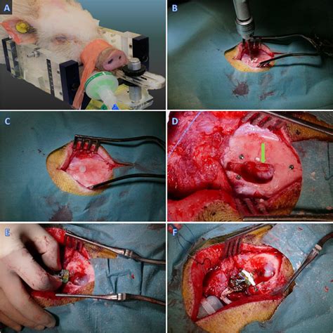An Intracortical Implantable Brain Computer Interface For Telemetric