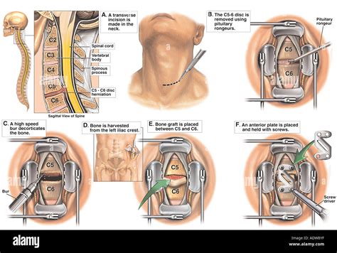 Cervical Spine Injuries With Proposed Spinal Fusion Surgery 52 Off