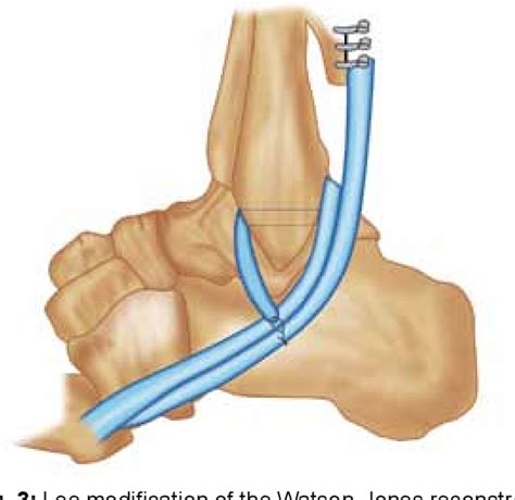 Figure 3 From Lateral Ankle Ligament Repair Evolution Of Technique