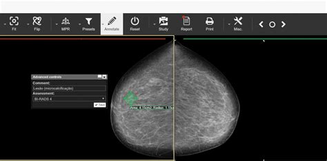 Automatic Detection Of Microcalcifications In Mammography Bmd Software