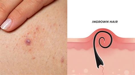 Ingrown Hair On Thigh How To Prevent Ingrown Hairs Philips