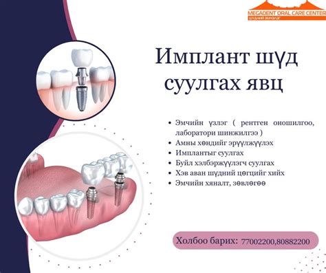 Ads Campaign Pro 🦷Шvдний имплант гэдэг нь нэг Vгээр хэлбэл хиймэл ёзоор бөгөөд тvvнийг тухайн