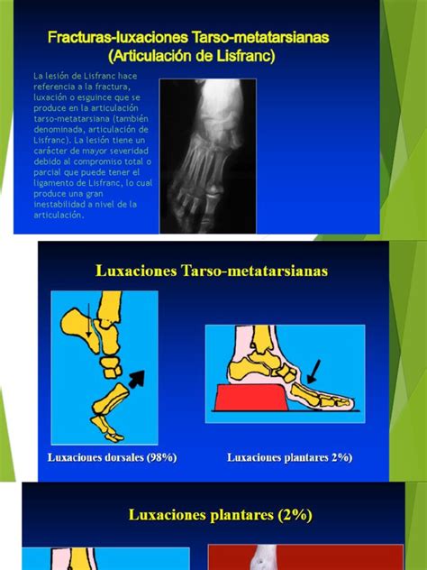 Lesión De Lisfranc Fractura Y Luxación Pdf