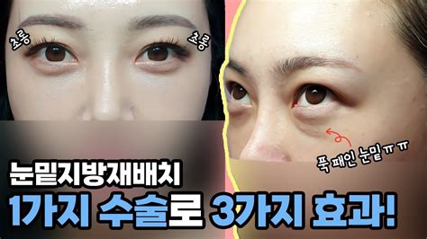 눈밑지방재배치로 애굣살앞볼리프팅눈밑개선 모두 가능 수술 전부터 3개월까지 찐 후기 알려드림 Youtube