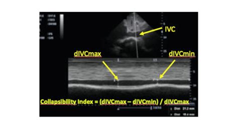 Ultrasound Measurements Of Inferior Vena Cava IVC And Calculation Of Download Scientific