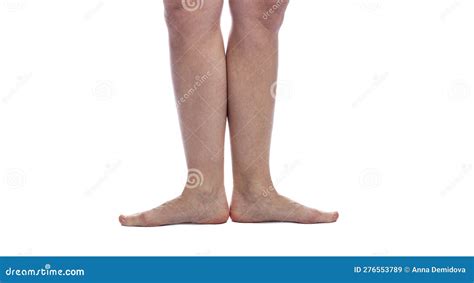 женская нога на колени с паутинными венами без лечения проблемы кровеносных сосудов Стоковое