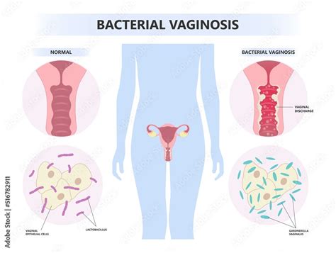 Types Of Herpes Simplex Virus Vagina Bacterial Sex Odor Fishy Foul