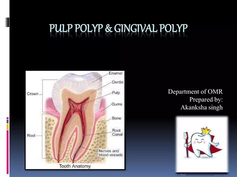 Pulp Polyp And Gingival Polyp PPTX
