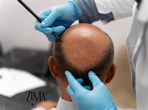 کاشت مو انواع روش، عوارض، مزایا و معایب سوالات پرتکرار زیمالب