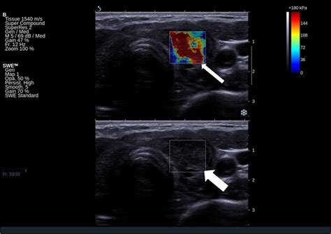 Patient 1 Heterogeneous Decreased Echogenicity Of The Left Thyroid Download Scientific
