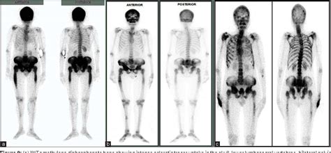 Figure 2 From An Unusual Presentation Of Metastatic Bone Disease In A Subject With Pagets