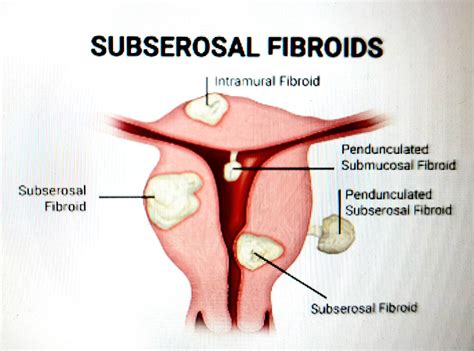 Ladieshealthutrinecare