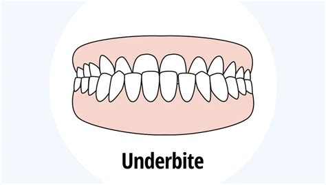 How Can Underbite Affect Your Health