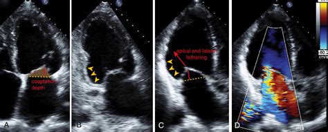 Secondary Mitral Regurgitation Clinical Tree