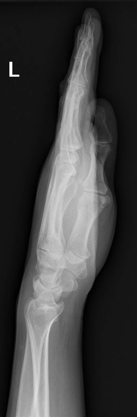 Metacarpal Fracture Return To Sport At Sandra Raines Blog