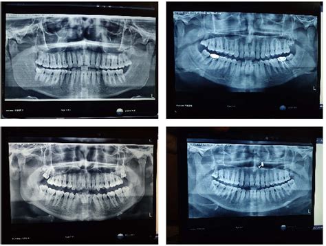 Figure From Semantic Segmentation On Panoramic X Ray Images With U Net Architectures
