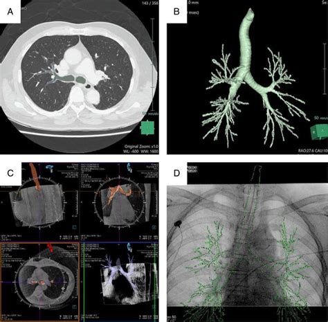 Image Fusion Of The Bronchus For Augmented Fluoroscopic Bronchoscopy
