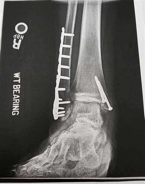 Bimalleolar Ankle Fracture R Radiology