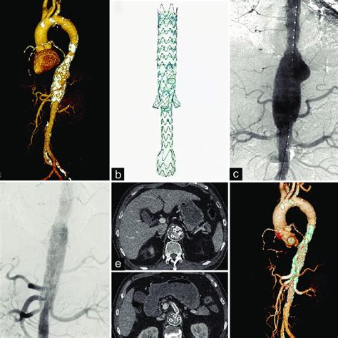 A Preoperative Computed Tomographic Angiography Demonstrates An