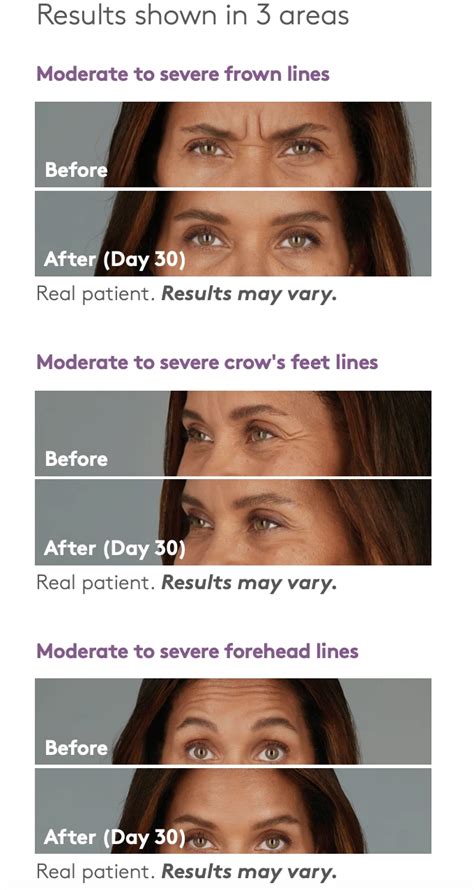 Preventative Botox Treatments The Amazing Way Botox Can Help Prevent Aging