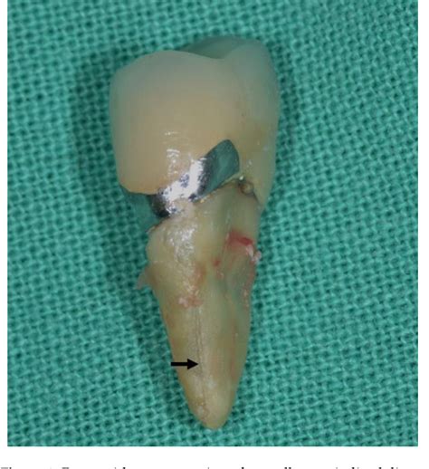 Figure 1 From Vertical Root Fracture In Non Endodontically And