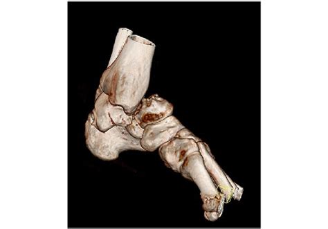 Ct Three Dimensional Reconstructed Sagittal Image Of A Left Sided