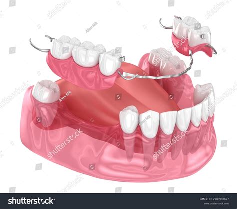 Removable Partial Denture Mandibular Prosthesis Medically Stock Illustration 2283993627 Removable Partial Denture Mandibular Prosthesis Medically Stock Illustration 2283993627
