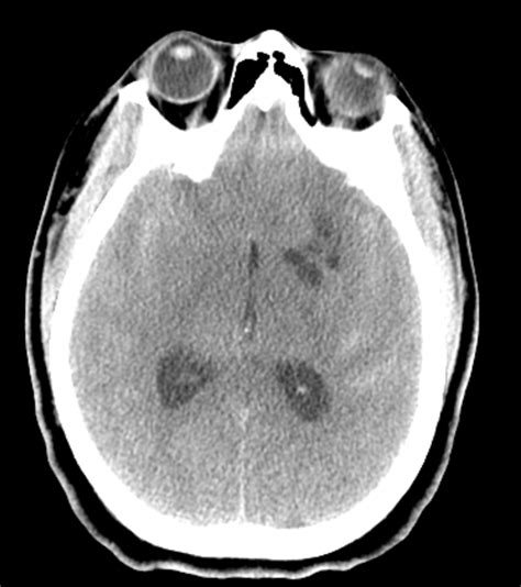 Pipeline Embolization Of Residual Ruptured Aneurysm