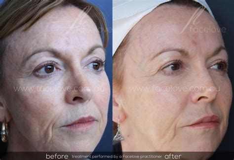 Skin Tightening With The Secret Micro Needle Fractional Rf Facelove