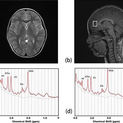 Voxel Displacement A Sagittal Mp Rage T1 Weighted Slice And B Axial