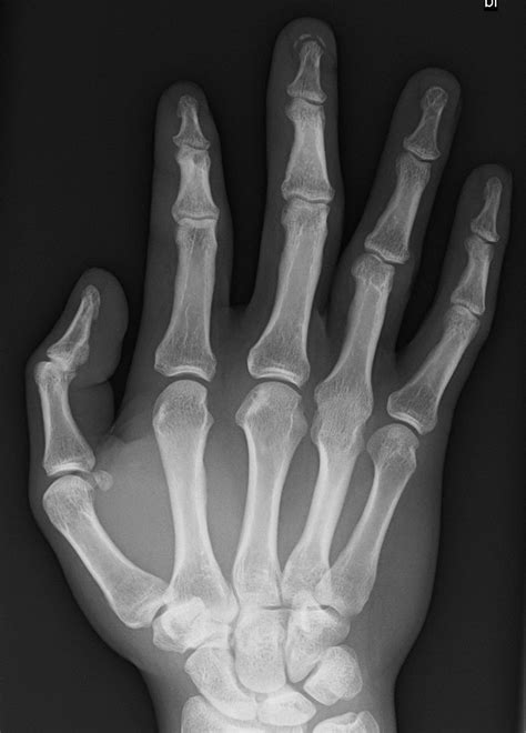 Mcp Prosthesis Beyond Osteoarthritis We Usually Perform Mcp Joint Replacements To Address