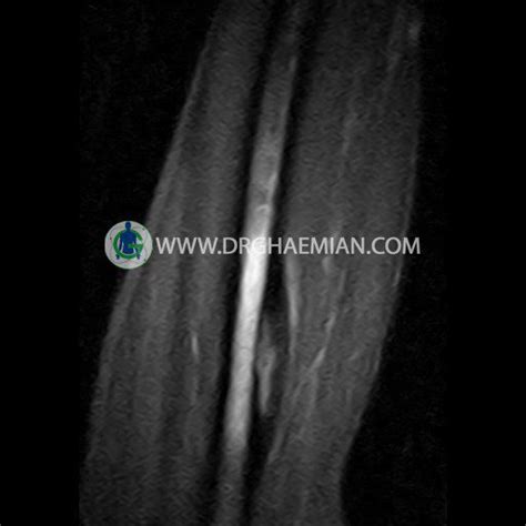 ام آر آی بازو چیست و چرا استفاده می شود؟ مرکز تصویربرداری پزشکی دکتر