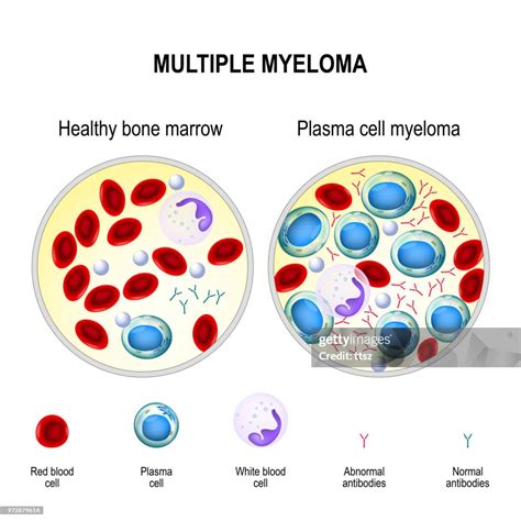 Multiple Myeloma Plasma Cell Myeloma High Res Vector Graphic Getty Images