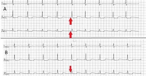 Ecg Rhythms Wandering Rhythm