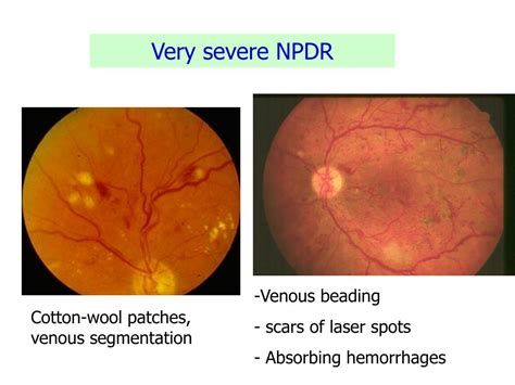 Ppt Diabetic Retinopathy Powerpoint Presentation Free Download Id