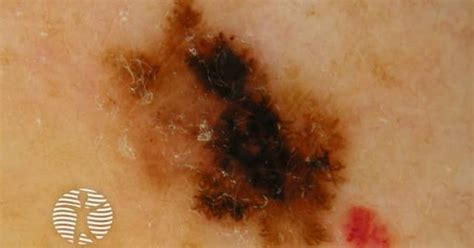 Superficial Spreading Melanoma Dermoscopy Image