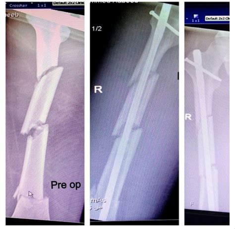 Mohammed Nassri On Linkedin This Is A 17 Years Old Male Patient Case Or Rta Diagnosed As Right