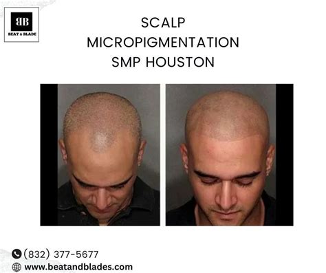 In Houston How Much Does Scalp Micropigmentation Smp Cost Beat And
