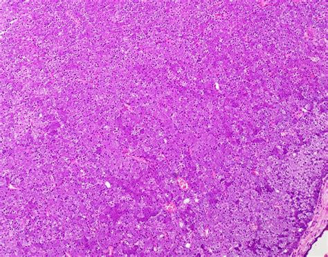 《腺泡细胞癌》在“两腺”游玩时的所见所闻 资讯频道 华夏病理网